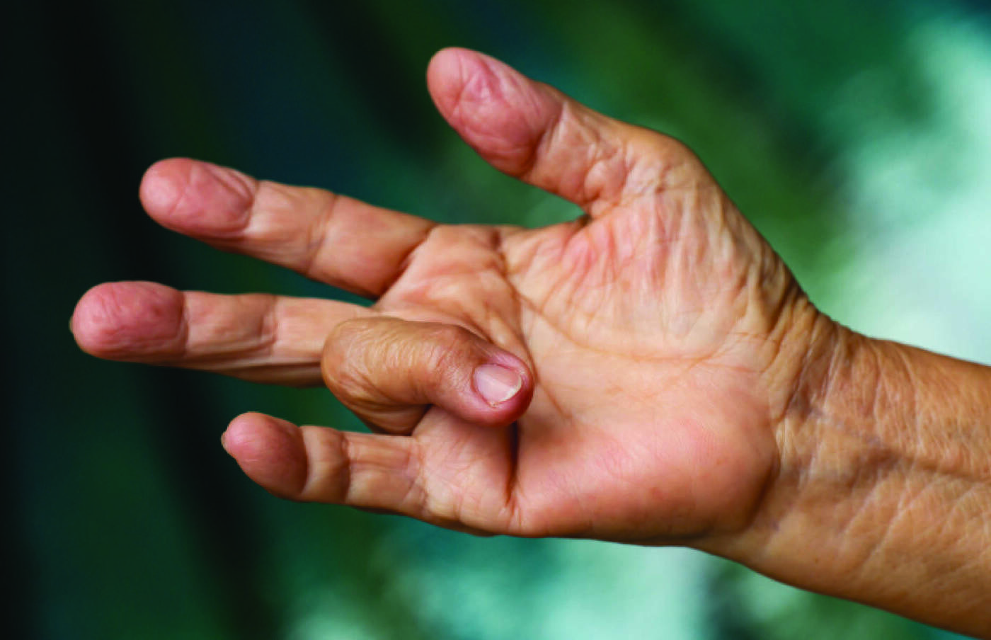 Patient Story: Saying Goodbye to Trigger Finger | News & Stories ...